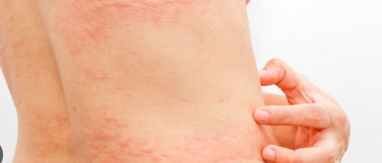 Alerji Nedir, Alerji Türleri ve Etkilenen Sistemler - DS Haber